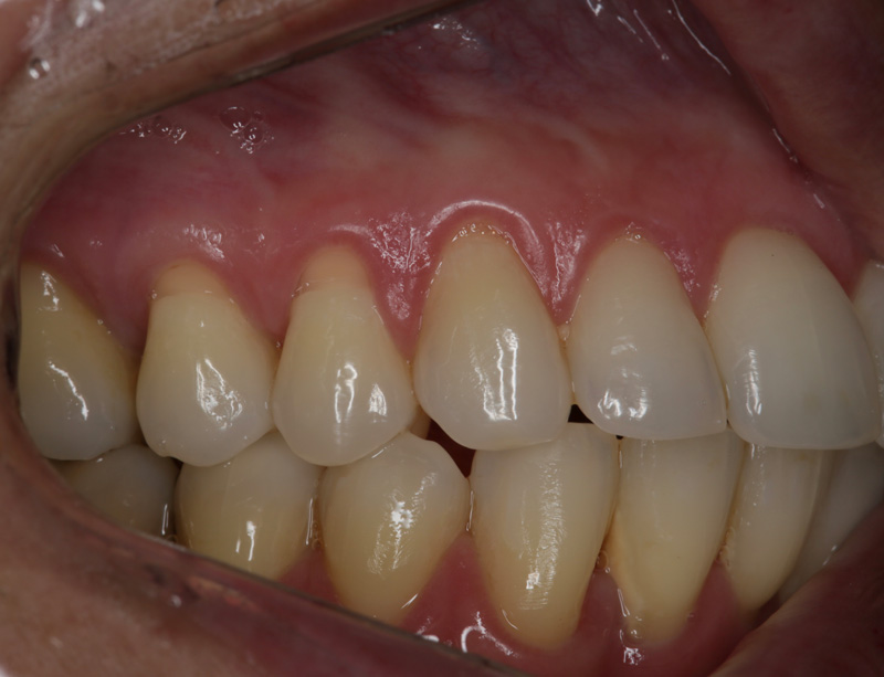 Retração/Recessão Gengival – Ruzzarin Odontologia