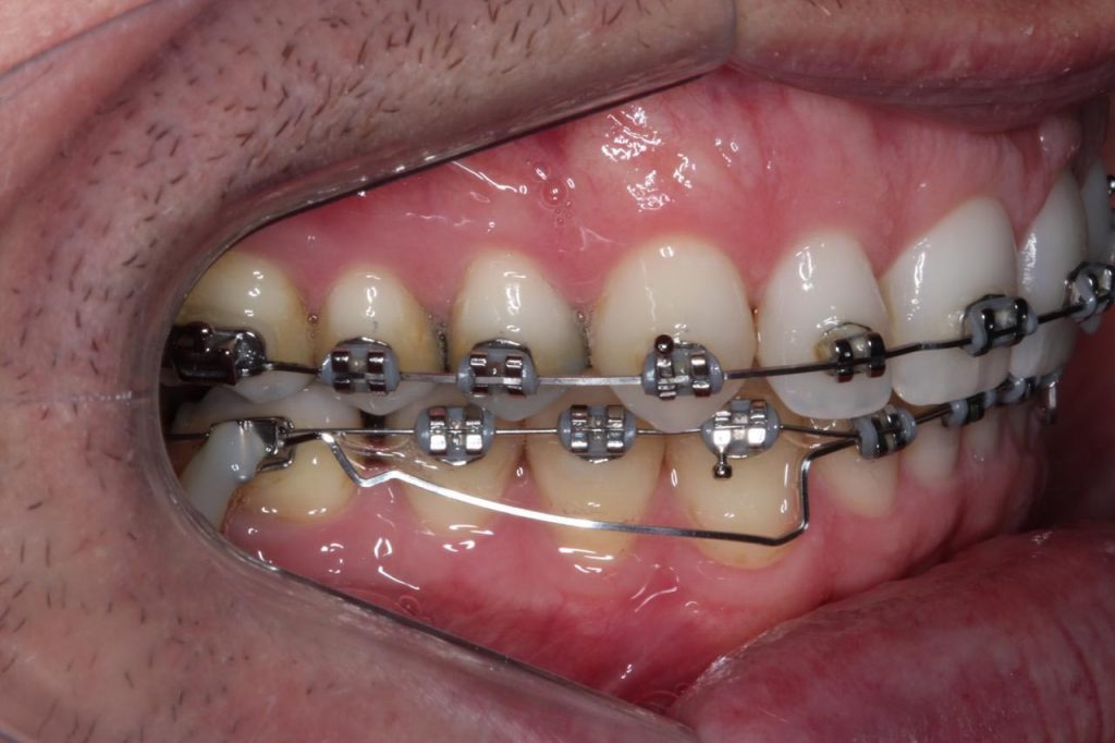 Disfunção de ATM - Clinica Ruzzarin Odontologia